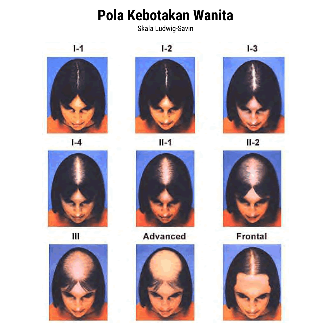 4 Jenis Kebotakan Rambut: Gejala, Penyebab, dan Solusinya
